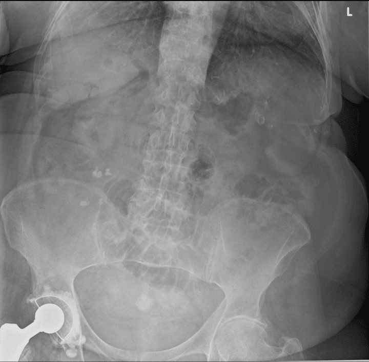 Rigler triad - Medicine Question Bank