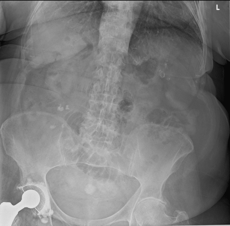 Rigler triad - Medicine Question Bank